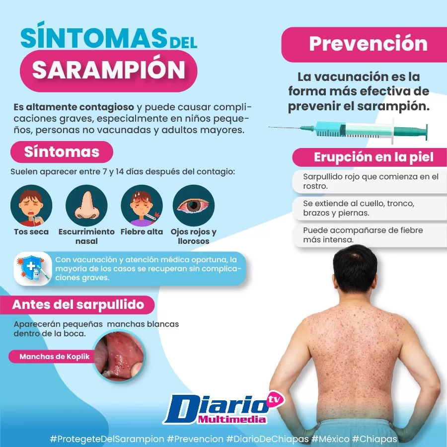 🦠⚠️ ¡Alerta por sarampión! Conoce los síntomas y cómo prevenirlo ...